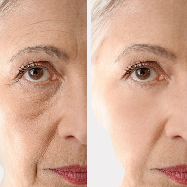 Loose Skin On Face - Hansplace