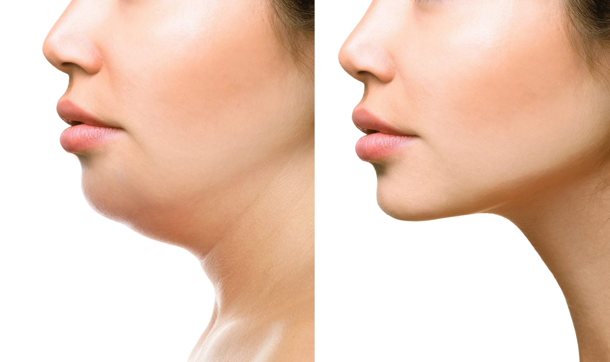 Best Ways To Get Rid Of Chin Fat - Hansplace
