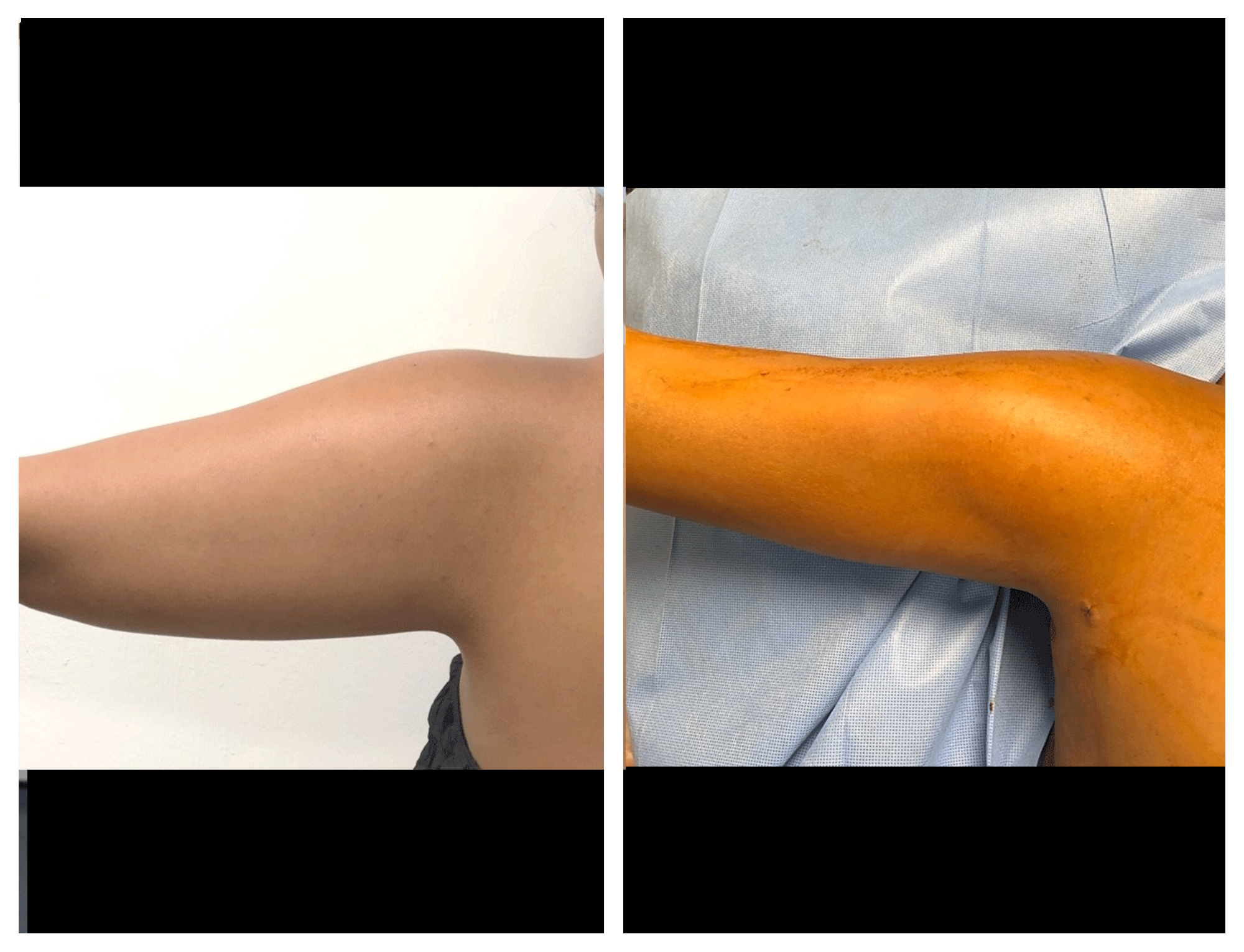 Upper Arm Fat And Vaser Liposuction Hans Place Practice Hans Place