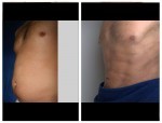 VASER Hi-Def & Mid-Def Liposuction Procedure | Hans Place Practice